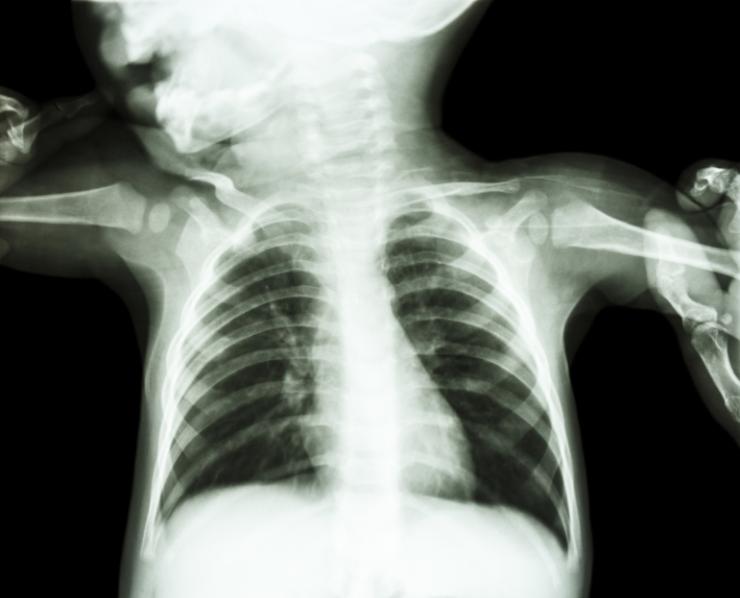 Wilms' tumor: Symptoms, treatment, and causes