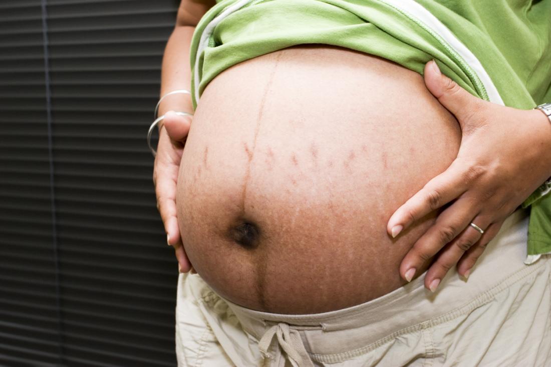 Stretch Marks Causes And Treatments Stretch Marks Causes And Treatments