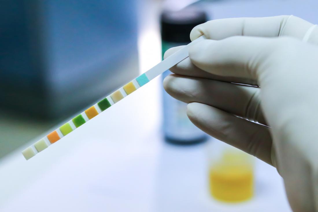 Urine Test For Diabetes Types Procedures Results