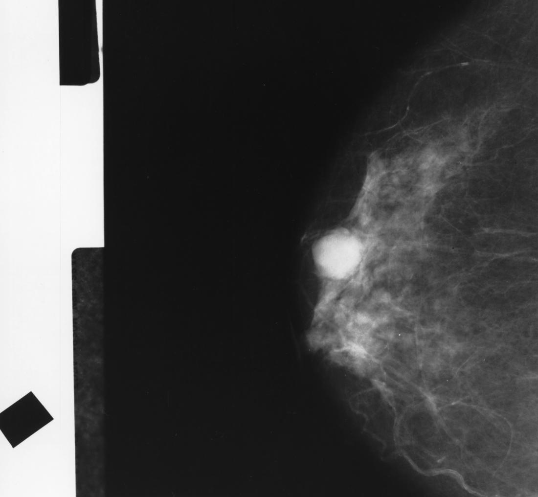 Mammogram Images