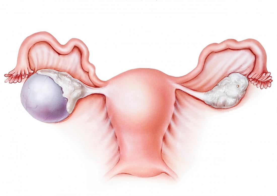 Complex Ovarian Cyst Symptoms Risks Pictures Surgery Complex Ovarian Cyst Symptoms Risks Pictures Surgery