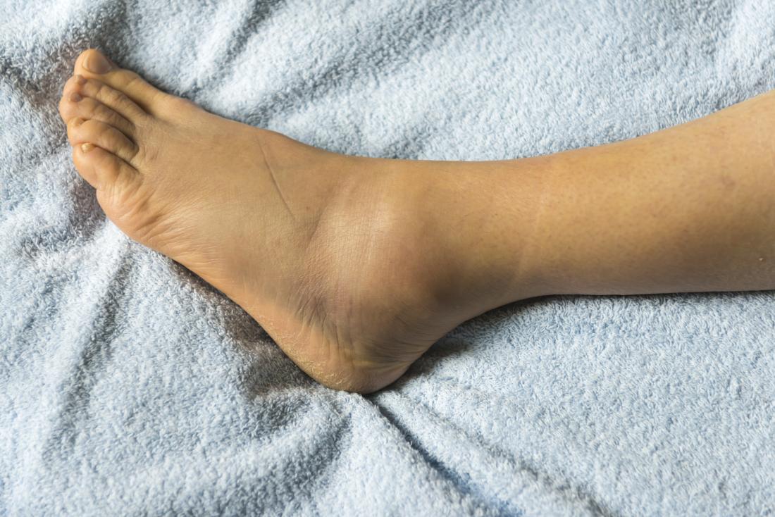 Swollen Feet 15 Causes Treatments And Home Remedies