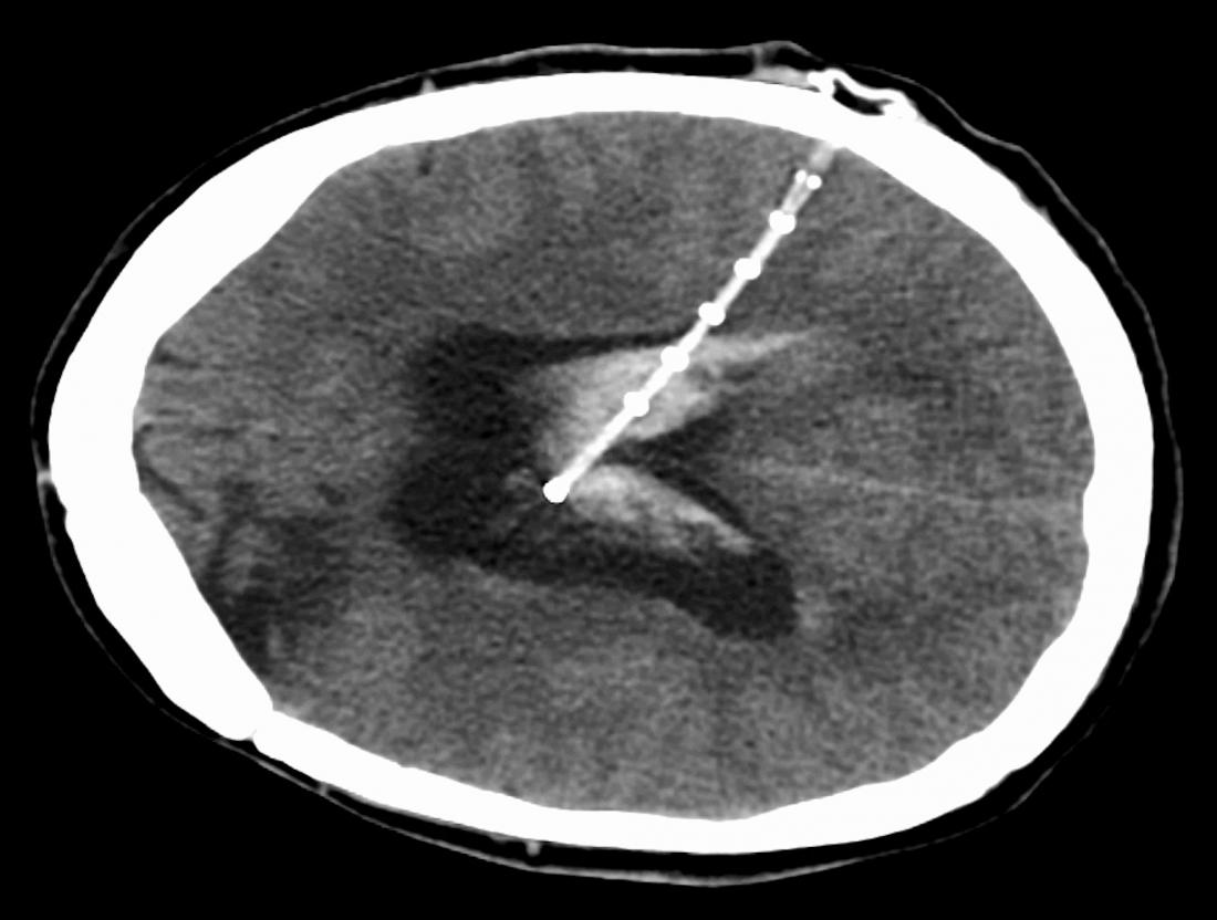 Ventriculoperitoneal Shunt Types Procedure Risks And Recovery Ventriculoperitoneal Shunt Types Procedure Risks And Recovery