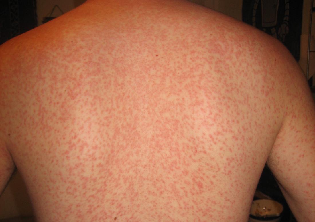 Streptococcal Pharyngitis Rash