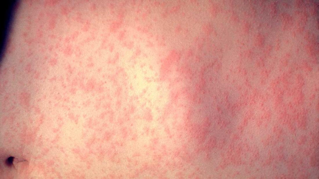 Sore Throat And Rash Strep Infection And Other Causes Sore Throat And Rash Strep Infection And Other Causes