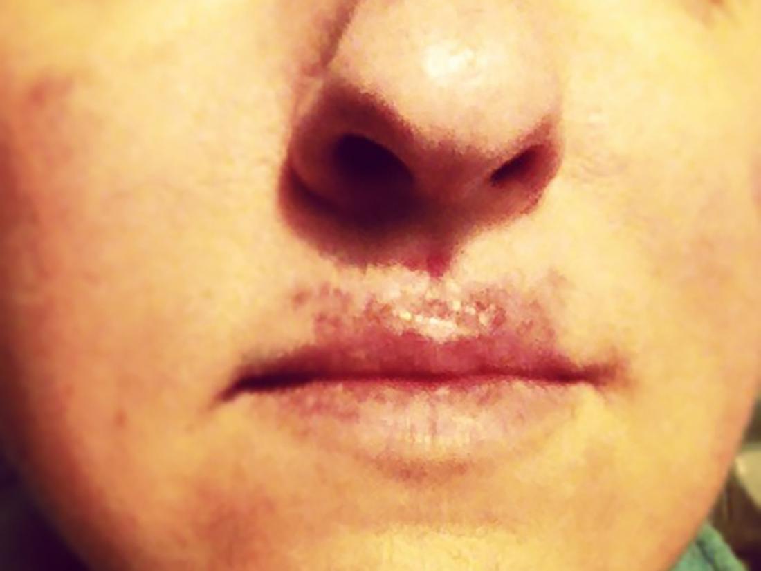 Skin Cancer On Nose Early Stages Idaman Skin Cancer On Nose Early Stages Idaman