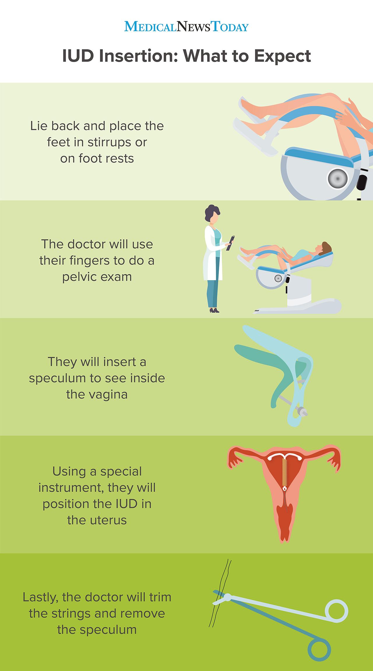 IUD Insertion A Guide And What To Expect IUD Insertion A Guide And What To Expect