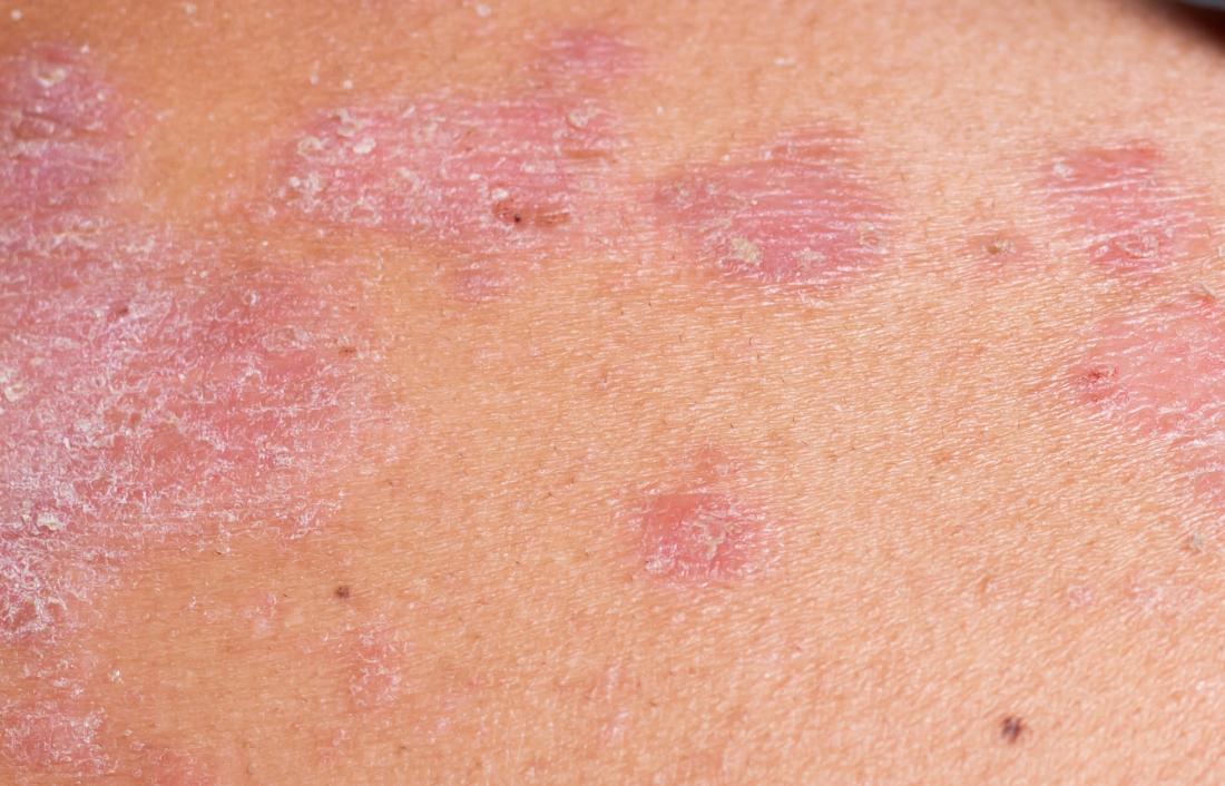 Itchy Rash Foreskin Itchy Rash Foreskin