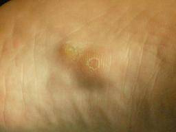 Ledderhose disease: Treatments, causes, and symptoms