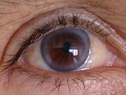 Arcus senilis: Causes, symptoms, and treatment