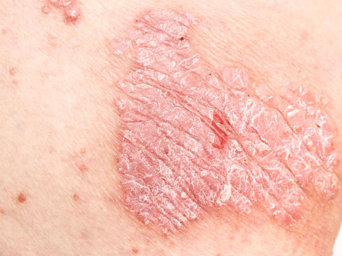 Genital Psoriasis Symptoms Treatment And Causes