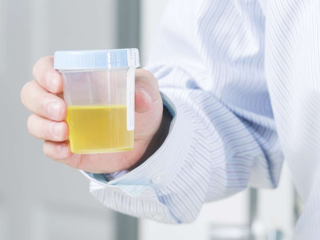 Epithelial Cells In Urine Test Results Types And Causes epithelial-cells-in-urine-test-results-types-and-causes