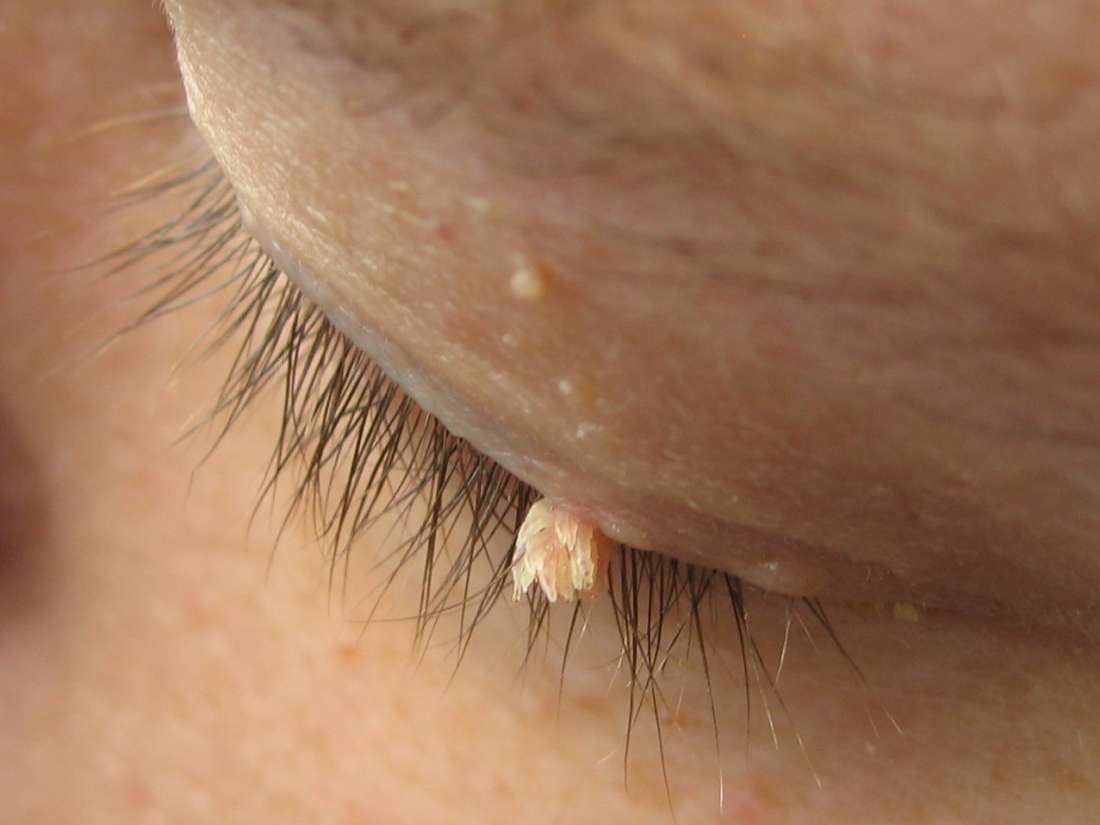 Skin Warts On Face Skin Warts On Face