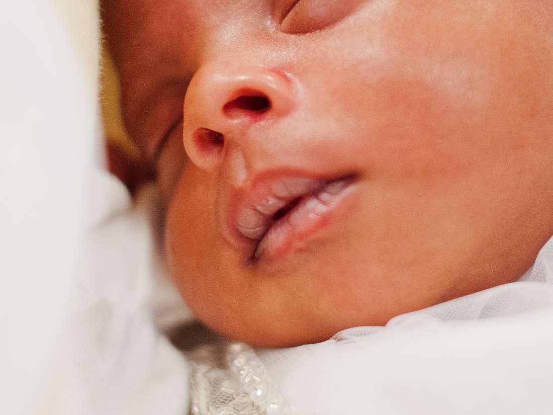 Newborn Chapped Lips Treatment And Causes Newborn Chapped Lips Treatment And Causes