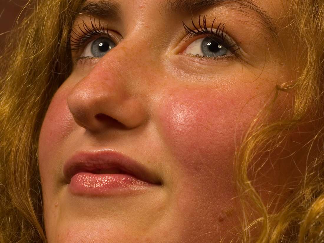 Flushed Skin Causes And When To See A Doctor Flushed Skin Causes And When To See A Doctor