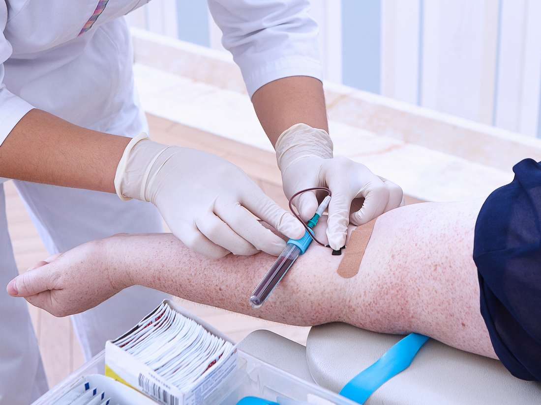 Eosinophil Count Test And Results