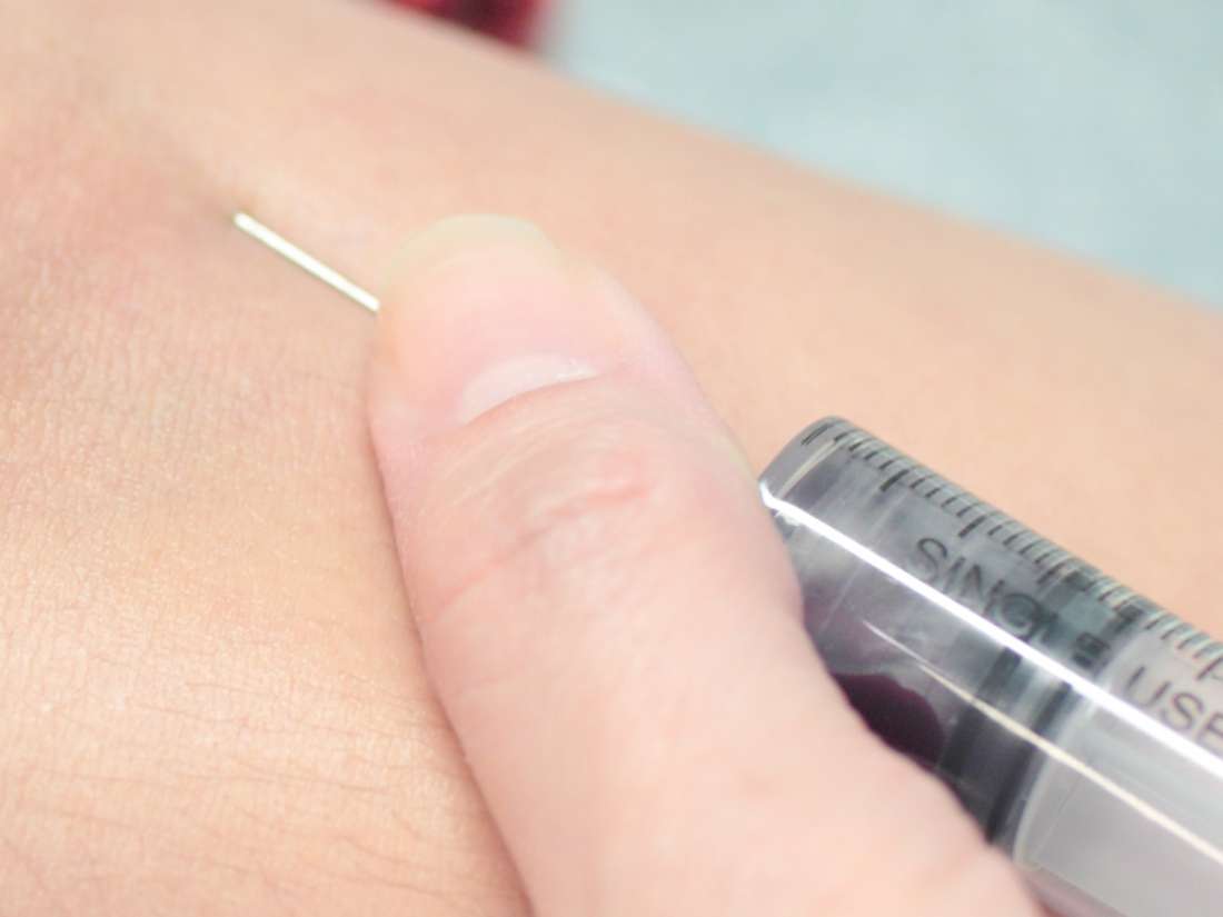 PPD Skin Test For Tuberculosis