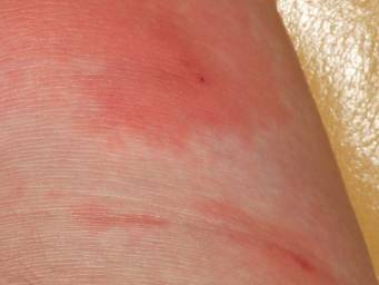 Cellulitis from bug bites: Signs, symptoms, and treatment